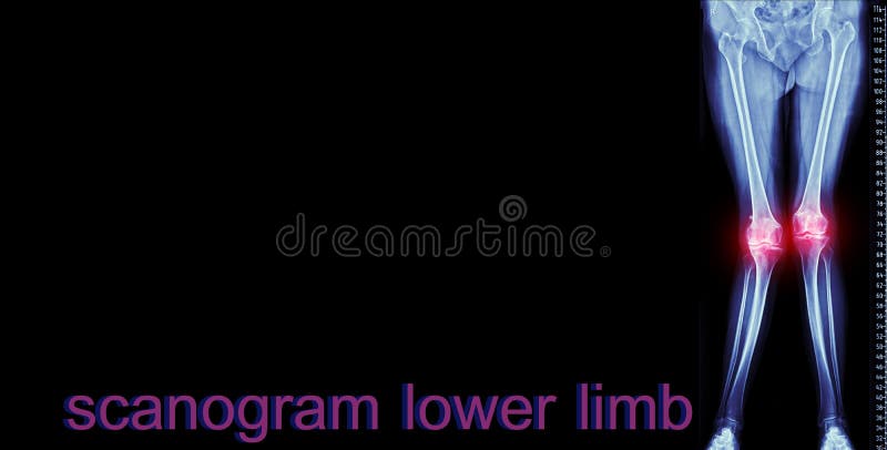Scanogram of Lower Limb or X-ray Image of Total Lower Extremity with ...