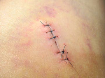 Scar stock image. Image of hurt, heal, medical, stitches - 11908451