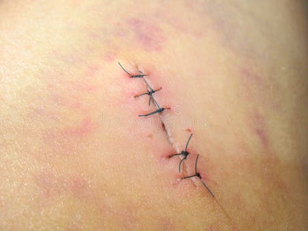 Scar stock image. Image of hurt, heal, medical, stitches - 11908451