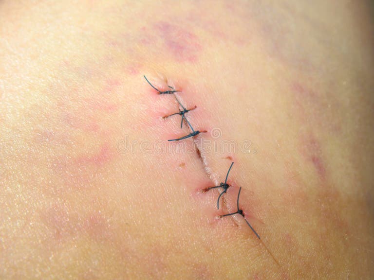 Scar stock image. Image of hurt, heal, medical, stitches - 11908451