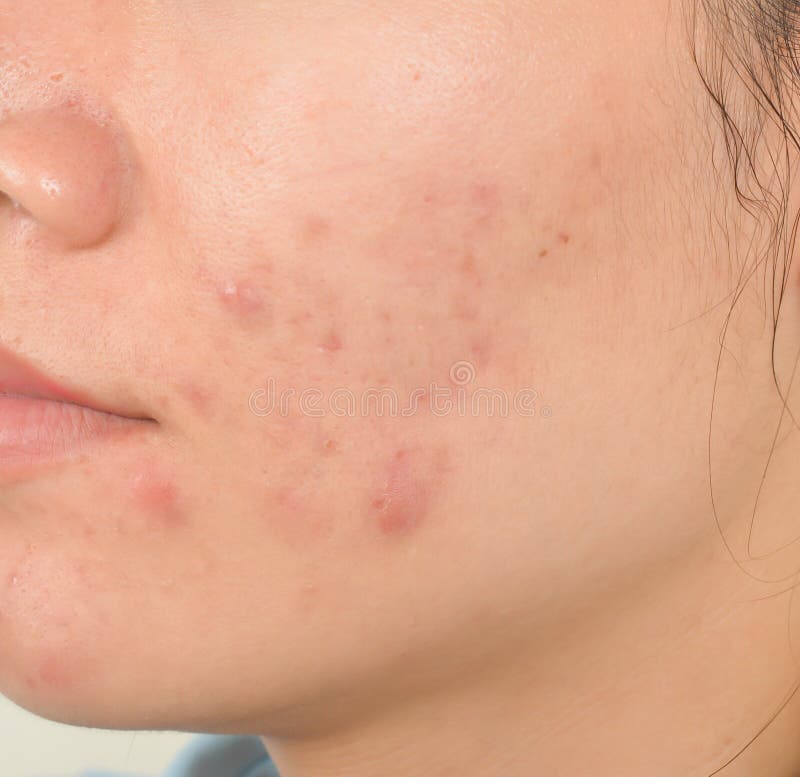 Scar from Acne on face stock photo. Image of dark, painful - 125385682