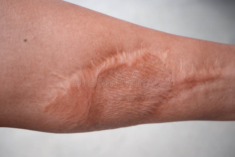 Scar on the arm stock image. Image of surgery, wound - 156602321