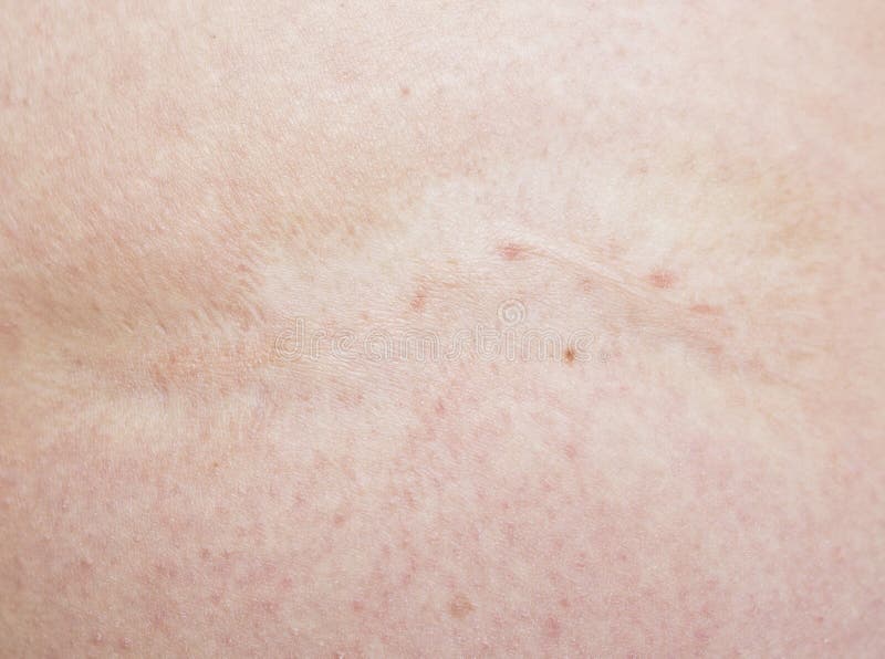 Scar stock photo. Image of bruise, stitch, hurt, care - 47952336