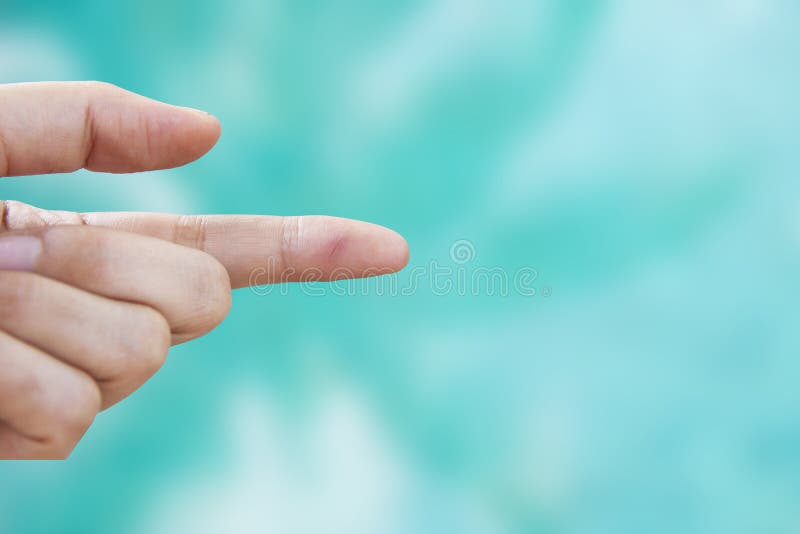 Scar on Female Finger with Space on Bourred Blue Background Stock Photo ...