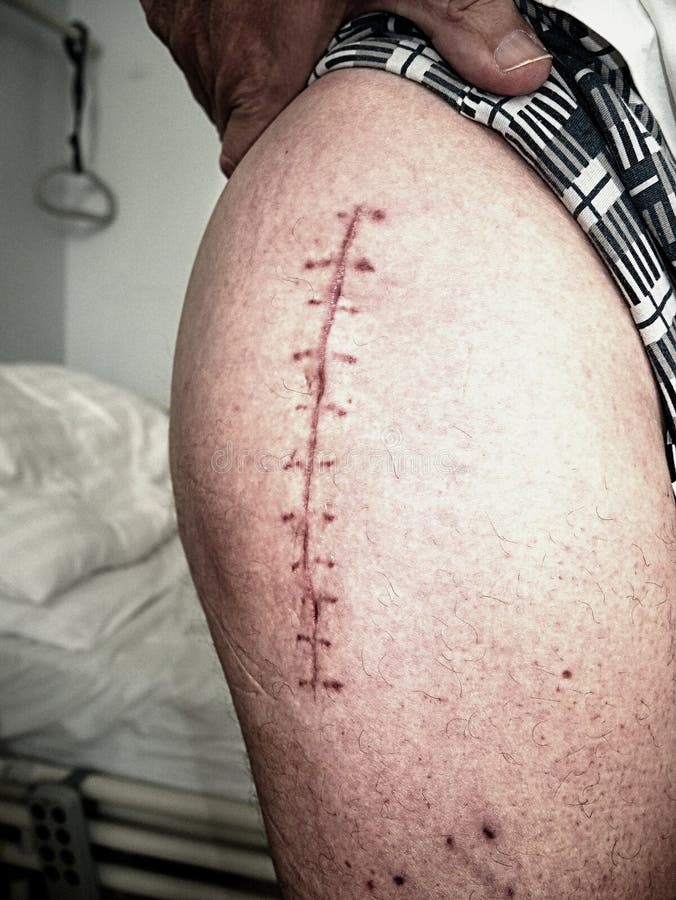 Scar Follow Surgery of Hip Joint. Replacing of the Devastated Hip Joint ...