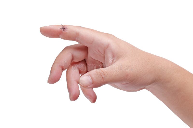 Scar on hand stock photo. Image of broken, recovery, patient - 25589706