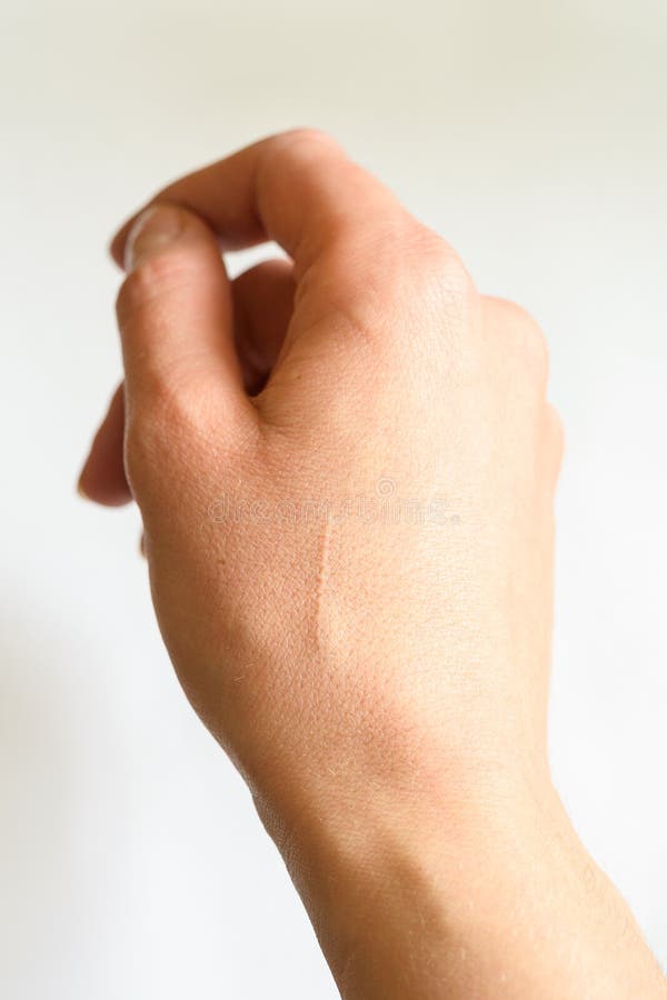 Scratch scar on arm stock image. Image of healthcare - 156865671