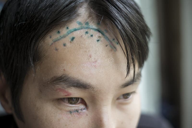 Scar on Eyebrow, Eyebrow Slit, Eyebrow Closeup Stock Photo - Image of ...