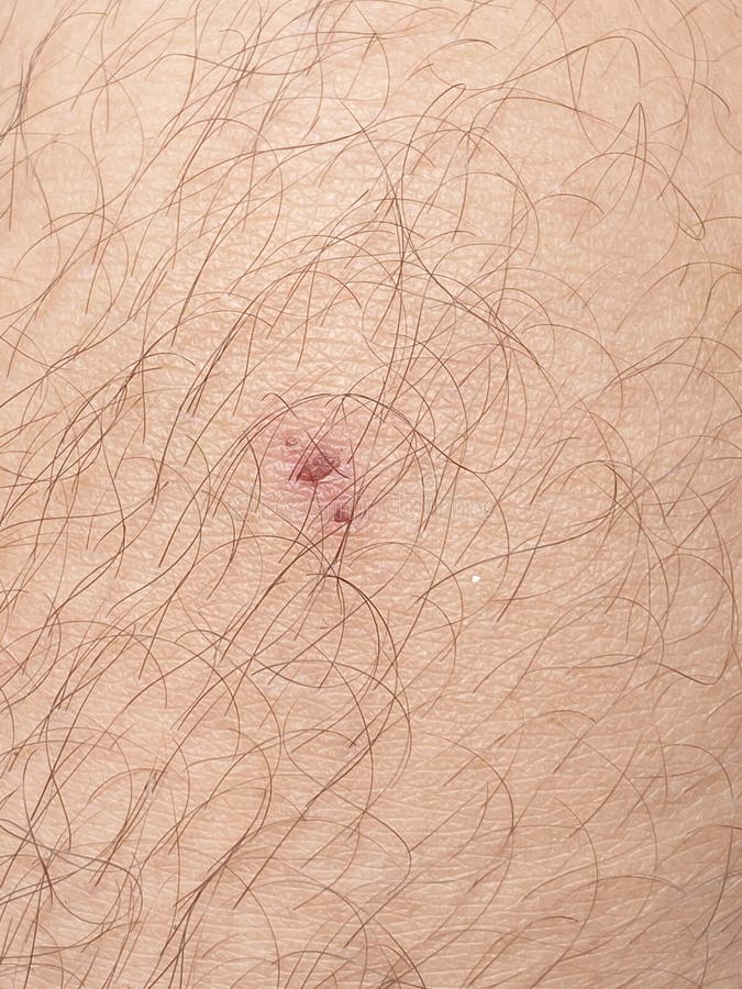 Scar on human body stock image. Image of macro, hair - 254620959