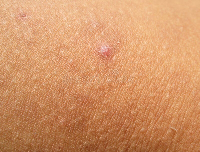 Scar on human skin stock photo. Image of skin, scar, healthcare - 59082544
