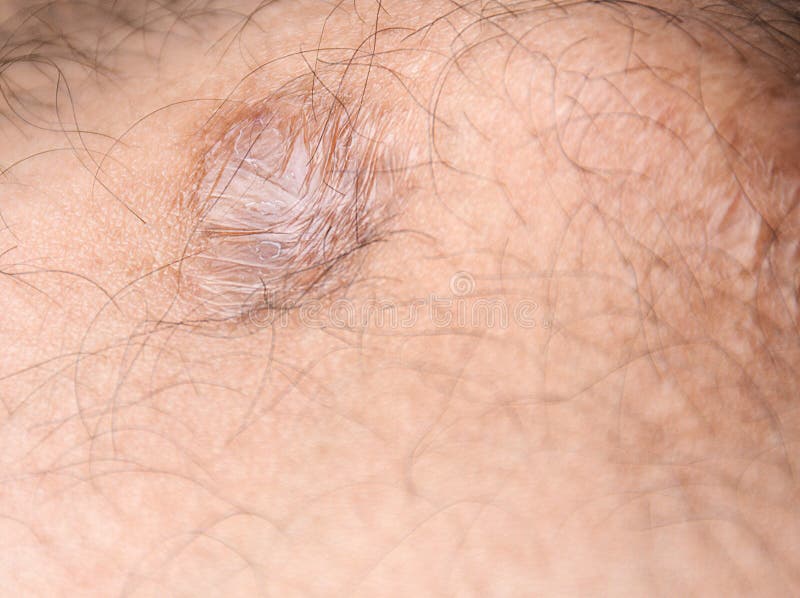 Torn Human Teeth On A Black Background. Close-up Photo Of Spoiled ...