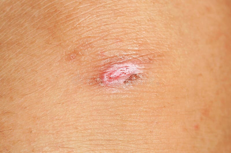 Scar on the knee stock image. Image of illness, senior - 93319723