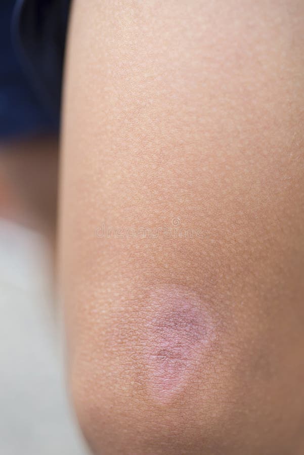 Scar marks on skin stock photo. Image of ailment, maul - 303116988