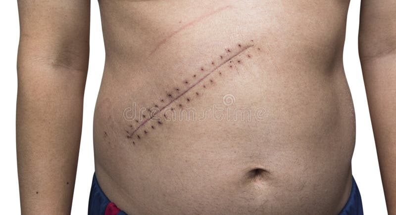 The Scar after Max Stitched Up Wound after Mole Removal Surgery / Skin ...