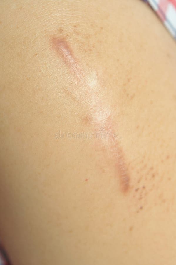 Scar - a Permanent Effect on Someone’s Mind. Stock Image - Image of ...