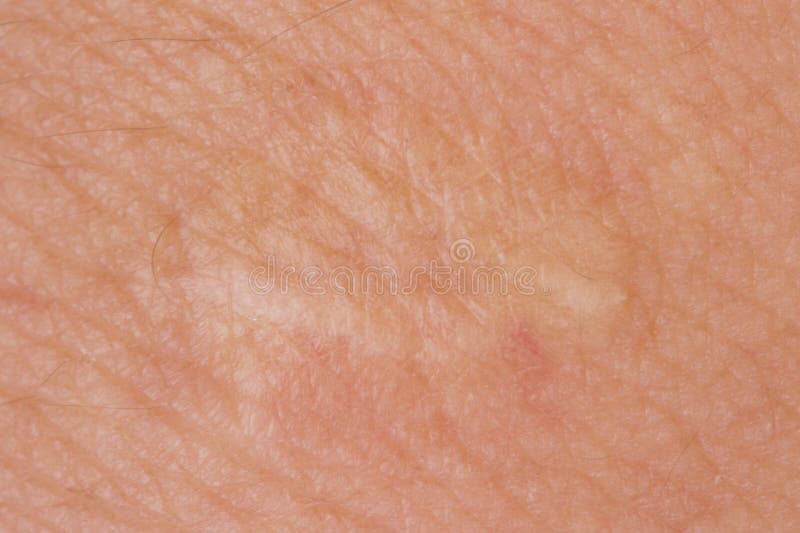 Scar stock photo. Image of injury, human, wound, medical - 38666494