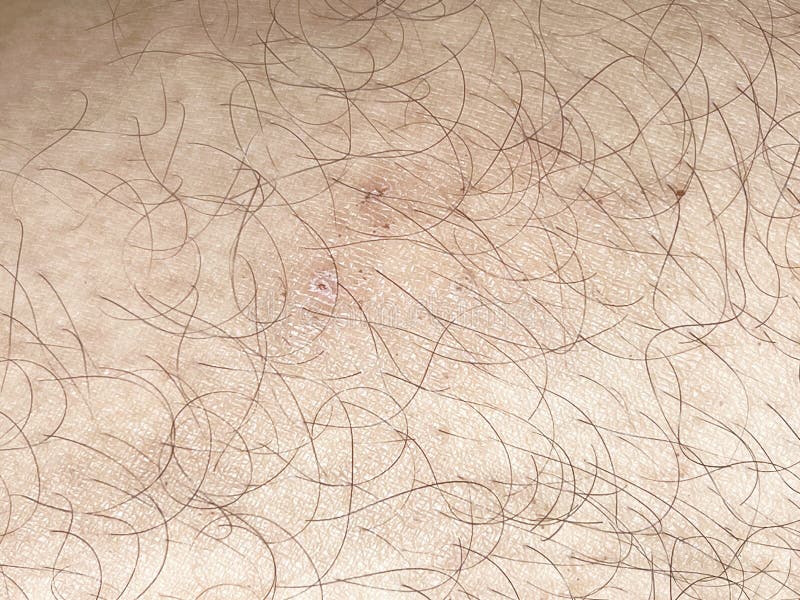 Scar on Skin. the Wound Form Scabs on Leg. Man with Long Scab Wound on ...