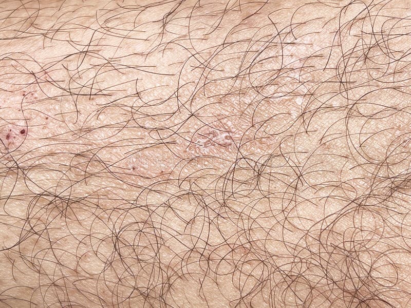 Scar on Skin. the Wound Form Scabs on Leg. Man with Long Scab Wound on ...