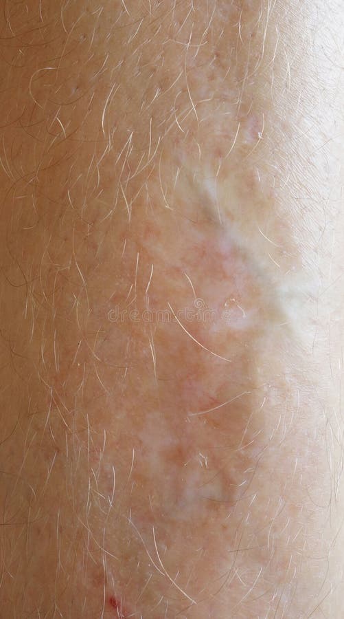 Scar on skin stock photo. Image of clip, health, stitch - 46166410