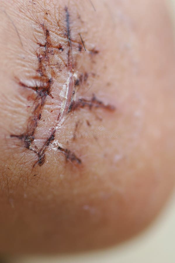 Scar with Stitches stock image. Image of closeup, scar - 9873333