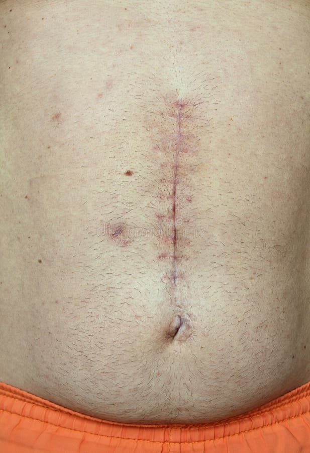 Pacemaker scar stock image. Image of arrhythmia, male - 31383145