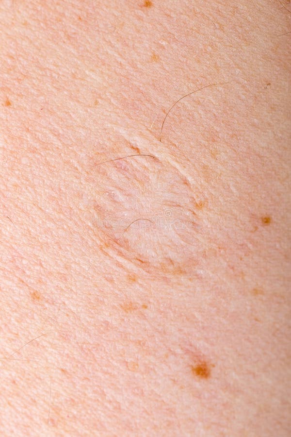 Scar on the human skin stock image. Image of harming - 44020179