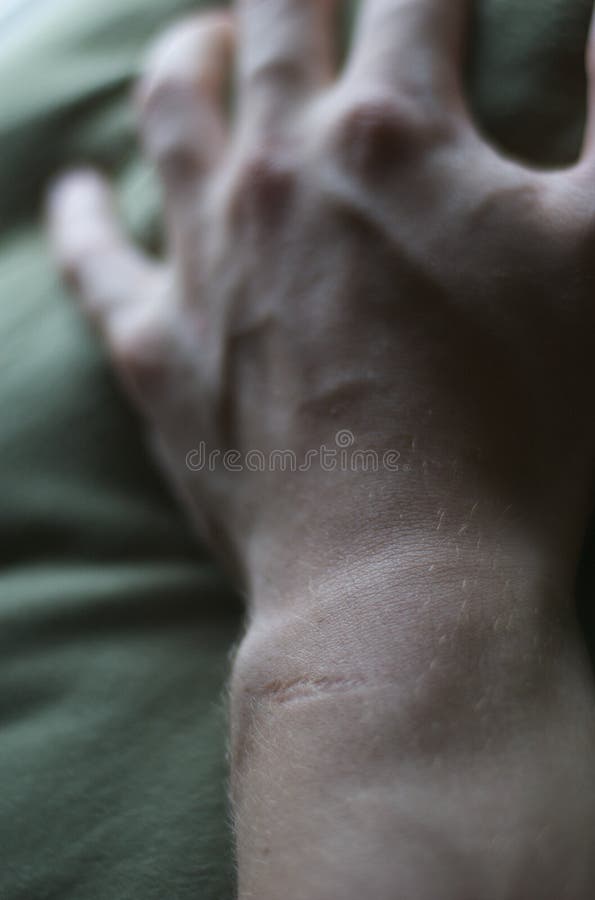 Scarred Wrist stock photo. Image of scarred, scar, drama - 5712636