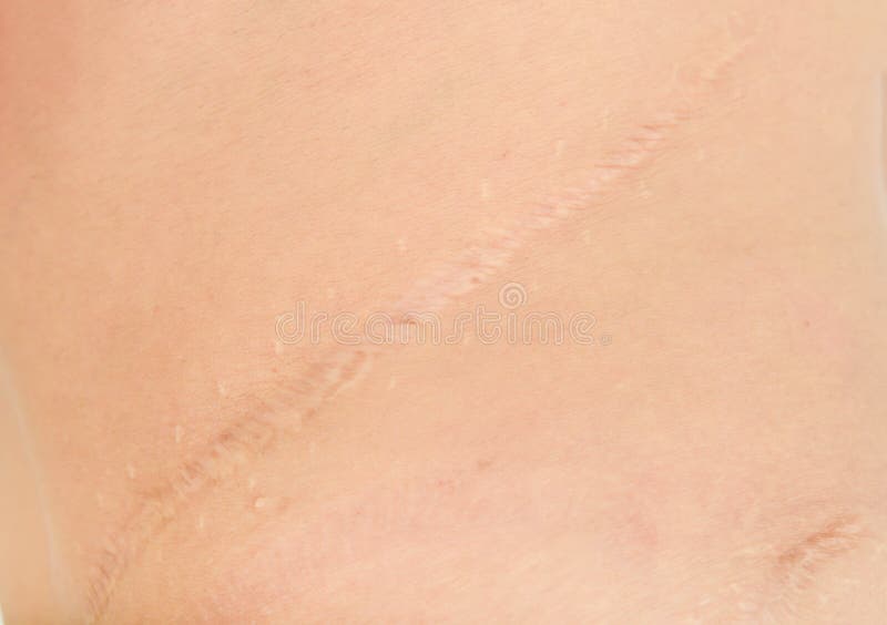 Scars in the body stock photo. Image of female, recovering - 125396546