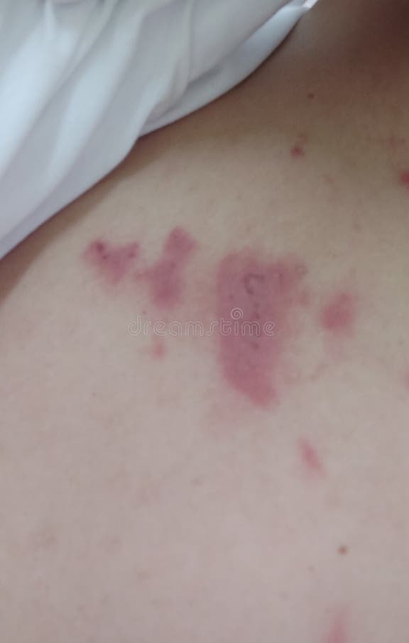 Scars Caused by Insect Venom Stock Image - Image of rash, irritation ...