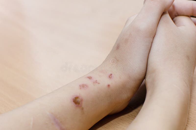 Scars from Cuts and Burns from Cigarettes on the Arm, Mental Problems ...