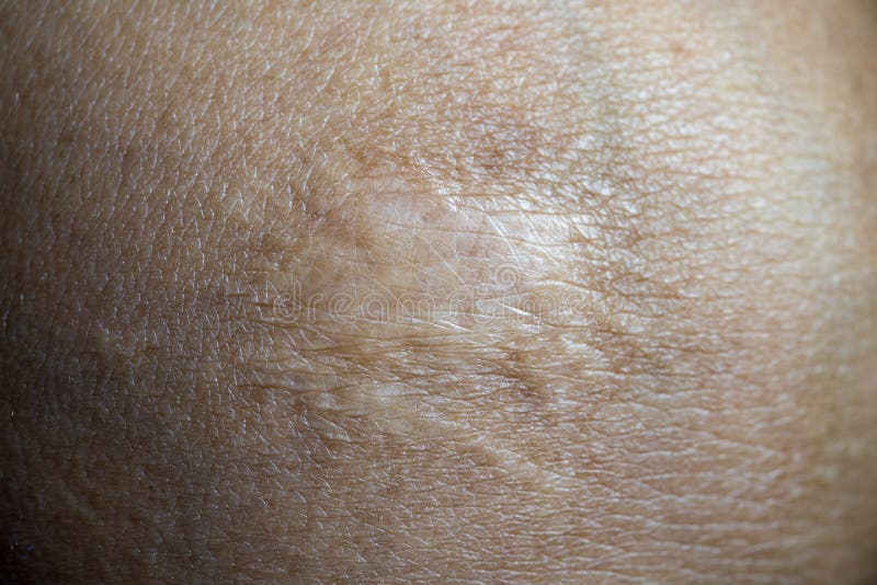 Scars Formed on the Human Body Stock Photo - Image of heal, incision ...