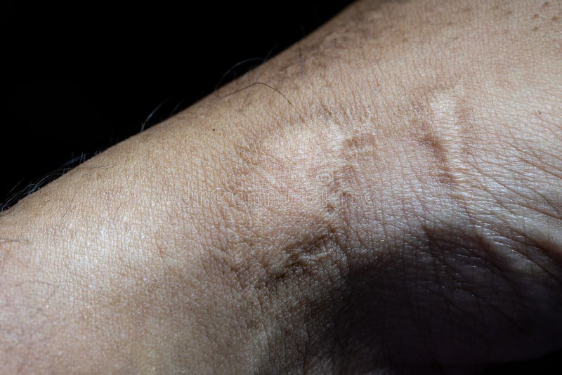 Scars Formed on the Human Body Stock Photo - Image of rough, aesthetic ...