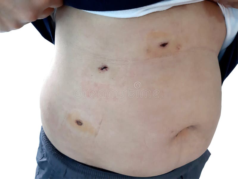 Scars from Gallbladder Surgery Stock Image - Image of cholecystectomy ...
