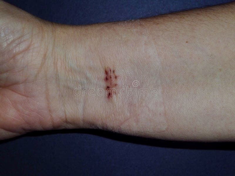 Scars on the Hand after Surgery Stock Photo - Image of dressing, person ...