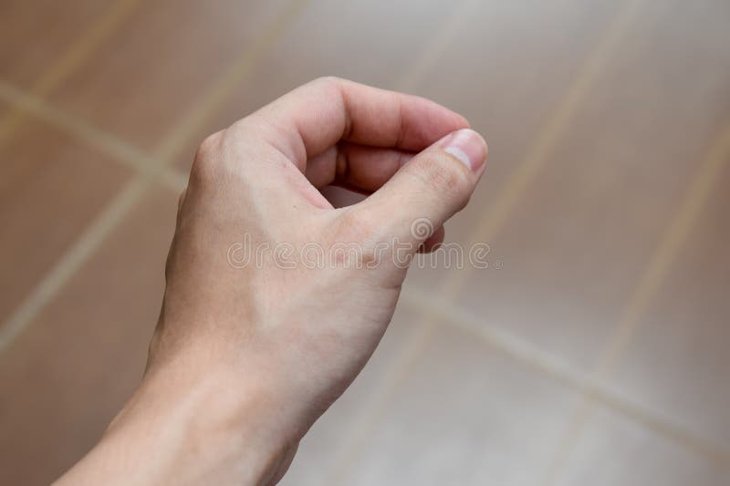 Scars on the Hands Caused by Wounds that Form Dark Spots Show the ...