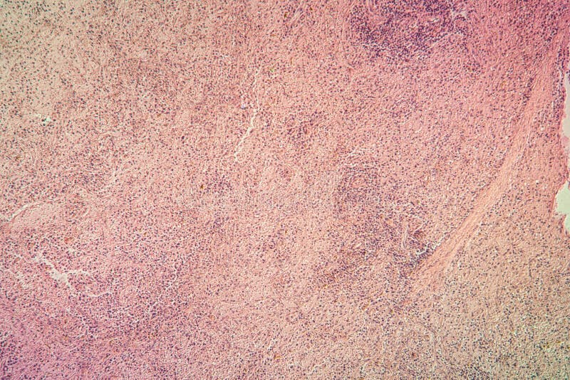 Scars in the Heart Muscle Tissue Stock Photo - Image of tissue, disease ...