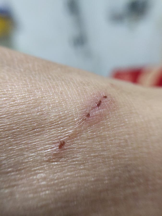 Scars on human skin stock photo. Image of pattern, painful - 209844688