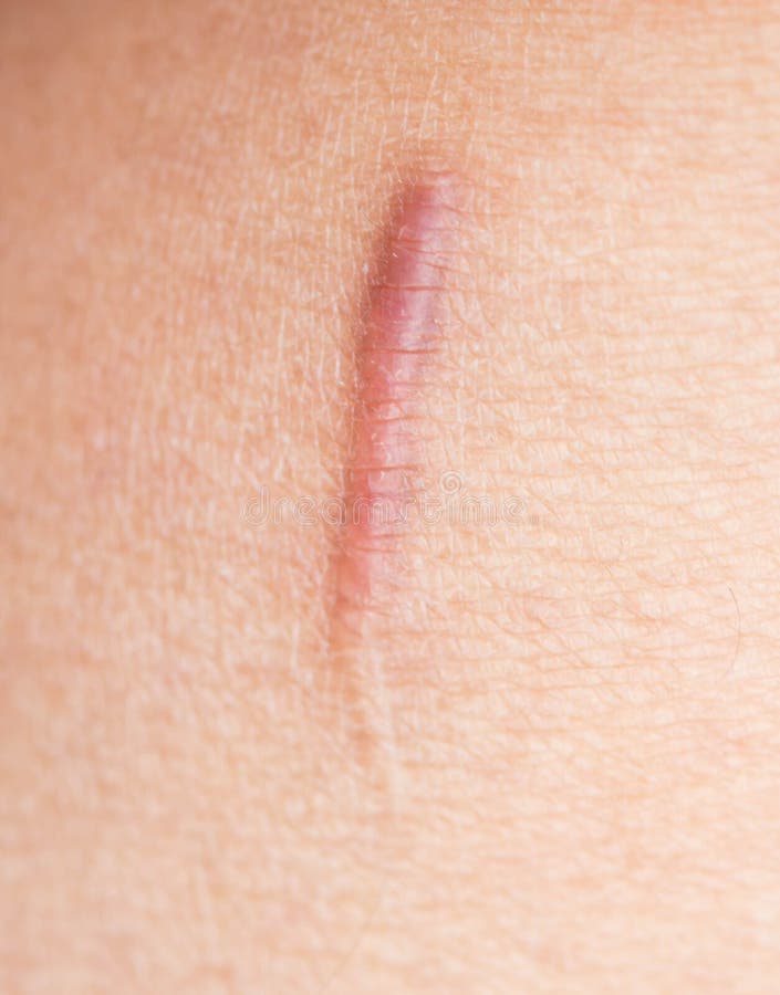 Scars On The Skin Around The Legs, Scar On A Girl`s Leg Close-up ...