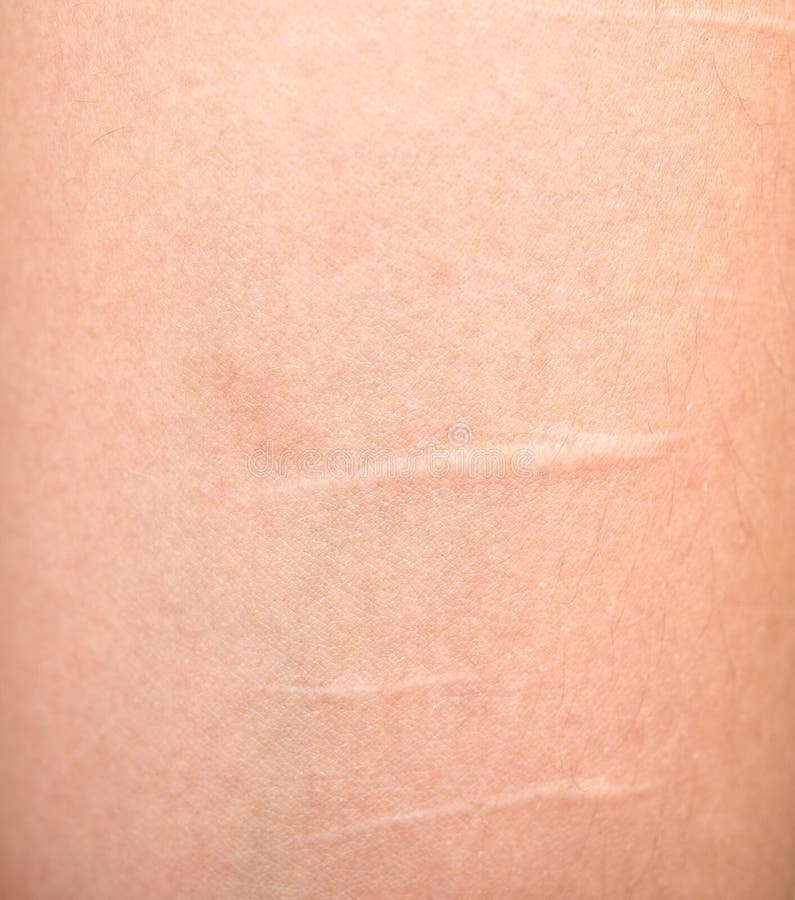 Scars on skin stock image. Image of belly, close, health - 193080517