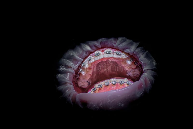 Devil-dental caries stock image. Image of care, caries - 35736943