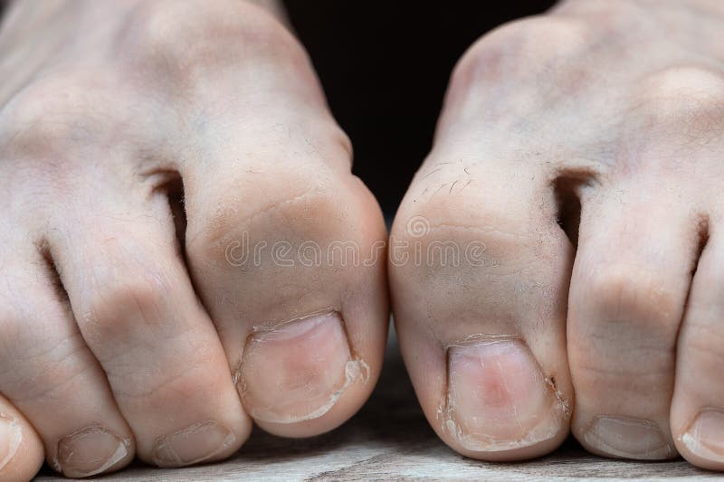 282 Sore Toes Stock Photos - Free & Royalty-Free Stock Photos from ...