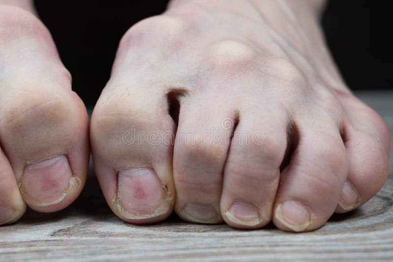 282 Sore Toes Stock Photos - Free & Royalty-Free Stock Photos from ...