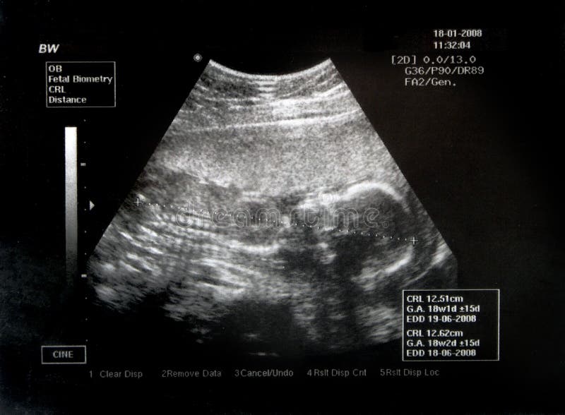 Ultraschall-Baby stockbild. Bild von mutterschaft, pränatal - 33362633