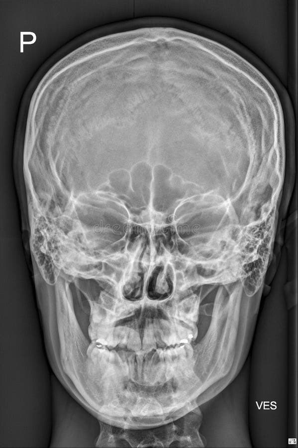 Schedel-hoofd Medische Röntgenstraal Stock Foto - Afbeelding bestaande ...