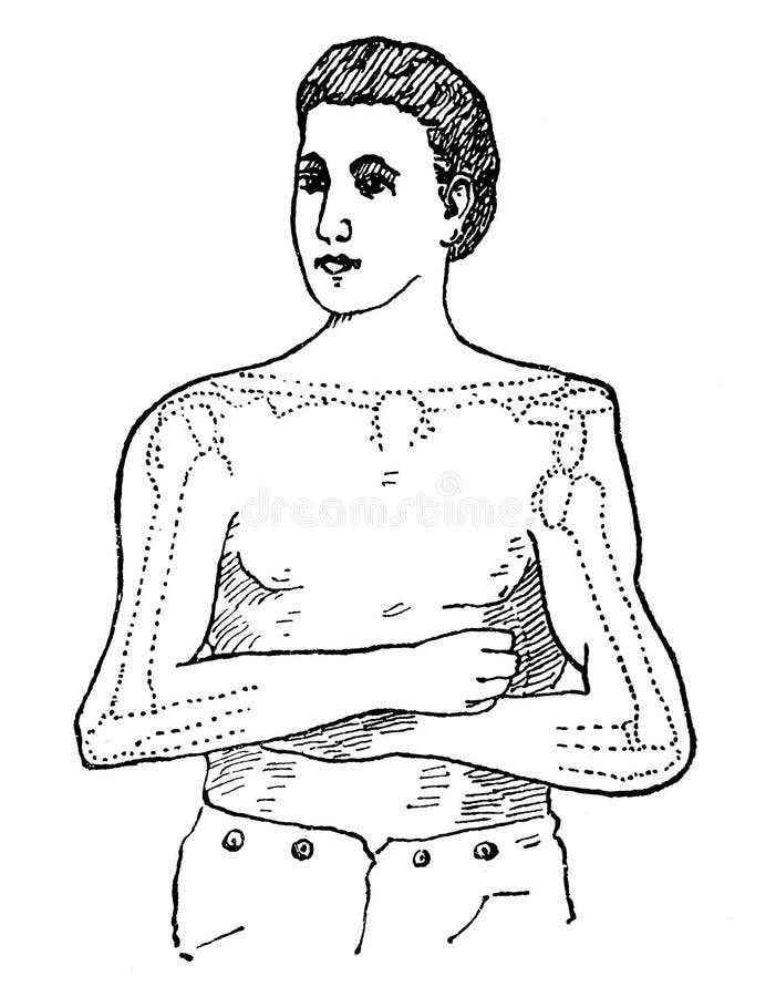 Dislocation Shoulder Symptoms or Separated. Stock Vector - Illustration ...