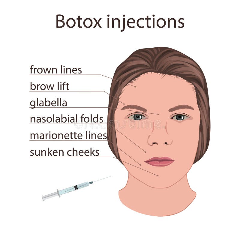 Scheme for Beauty Injections. Young Woman Face. Stock Illustration ...