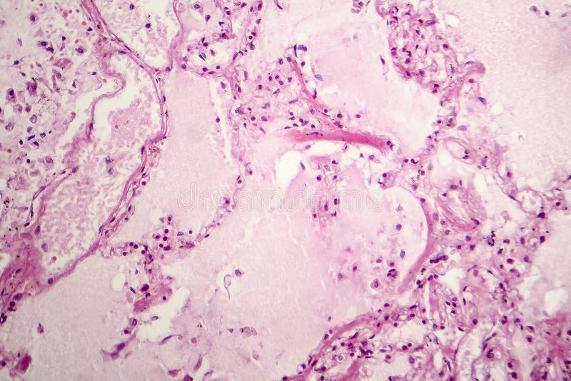 Scherp longoedeem stock foto. Image of scherp, oedeem - 120906070