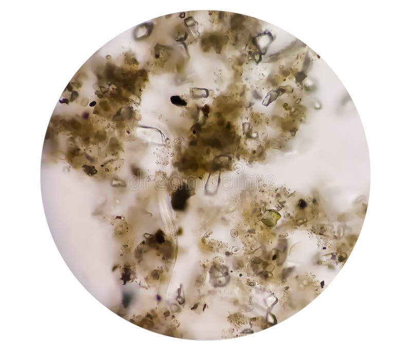 Schistosoma Ova in Human Urine Specimen Under Microscope. Stock Photo ...