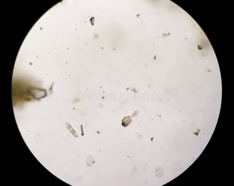 Schistosoma Parasite and Ova in Human Urine Specimen Under Microscope ...
