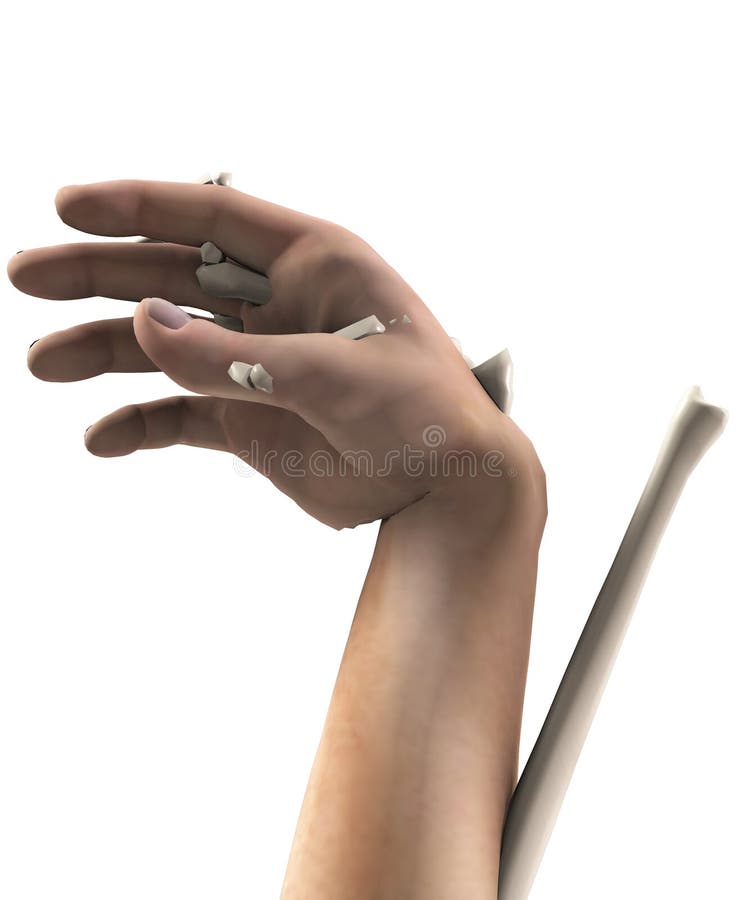 Schreckliche Handverletzung Stockfoto - Bild von verletzt, zertrümmern ...